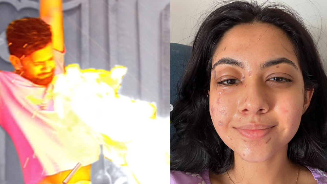Reem Shaikh के बाद अब इस पॉपुलर सिंगर के साथ हुआ हादसा, आग में झुलसा ...