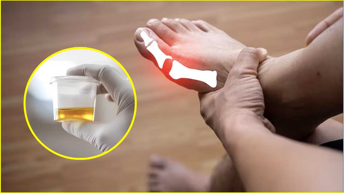 High Uric Acid के मरीज भूलकर भी न खाएं ये 7 फूड्स, एक्सपर्ट ने बताया ...