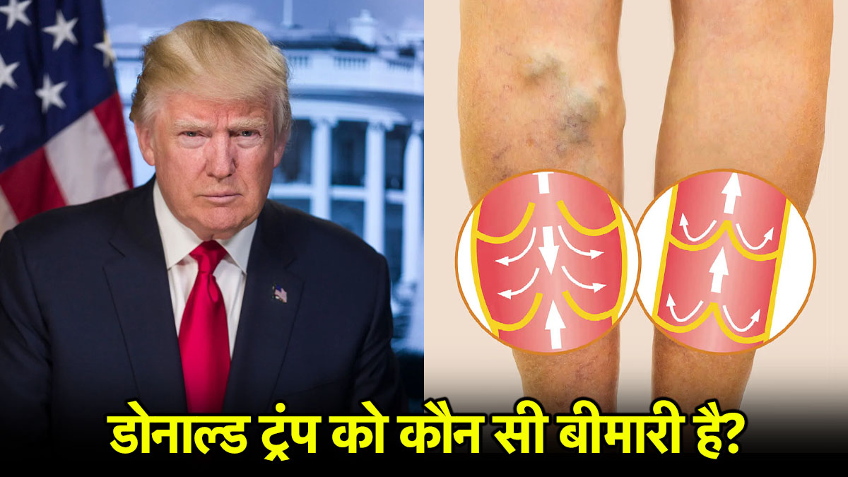 बिना वजह सूजन और बॉडी पर नीले निशान? कहीं आपको तो नहीं ट्रंप वाली ...