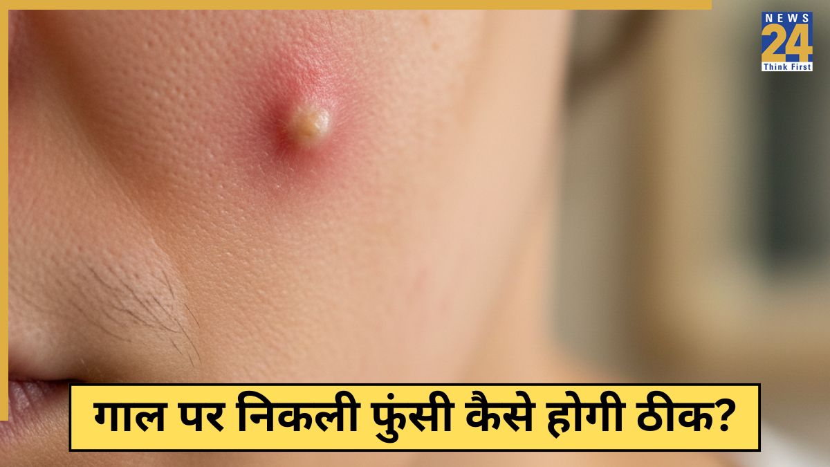गाल पर फुंसी क्यों होती है? यह दिक्कत हो सकती है वजह, जानिए पिंपल्स के ...