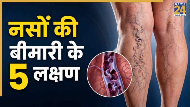 नसों की बीमारी के लक्षण कैसे दिखते हैं? वैस्कुलर सर्जन ने कहा पैरों पर ...